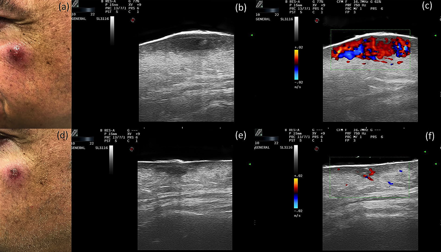 Dermatologic Ultrasound: Skin Deep Knowledge | The Scan