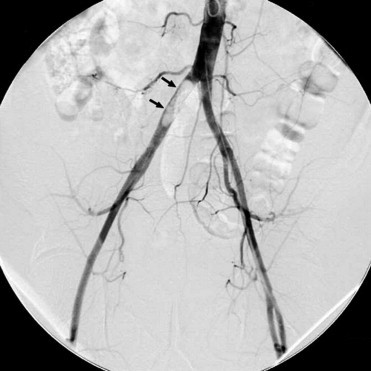 Duplex Ultrasound in Arterial Disease in Patients With Critical Limb ...
