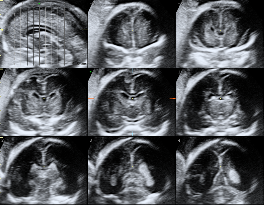 Fetal NeurosonographyThe Scan
